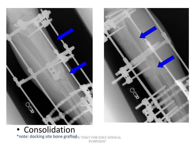 Principles of external fixator | PPT | First Aid | Injuries