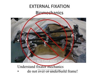 Principles of external fixator | PPT