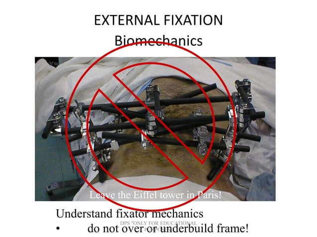 Principles of external fixator | PPT | First Aid | Injuries