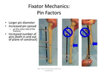 Principles of external fixator | PPT