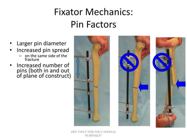 Principles of external fixator | PPT | First Aid | Injuries