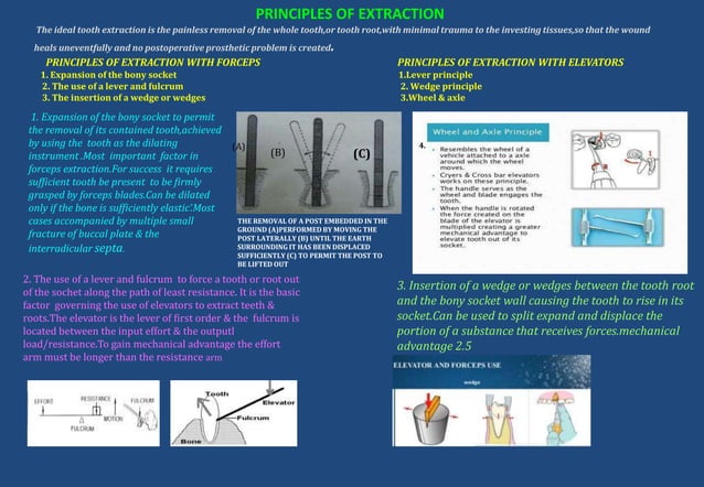 Principles of tooth extraction | PPTX | Dental Health | Diseases and ...