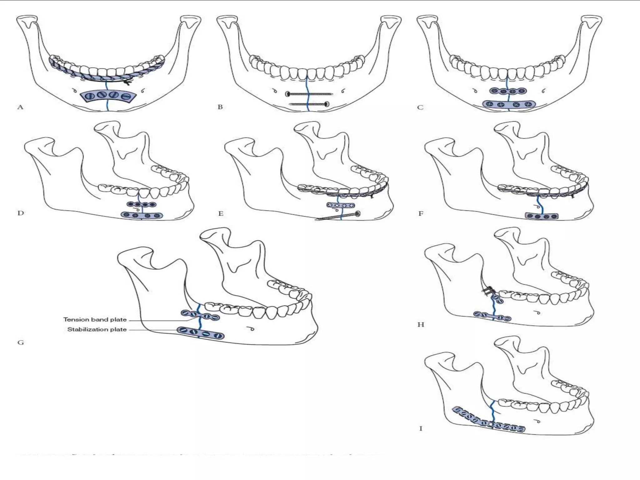 Principles of fixation and osteosynthesis in trauma | PPT
