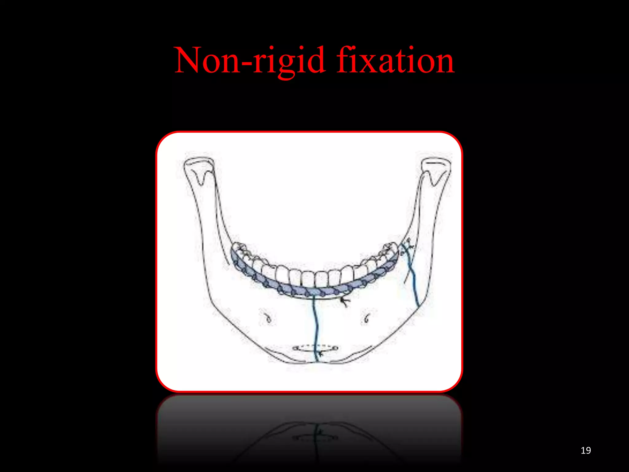 Principles of fixation and osteosynthesis in trauma | PPT