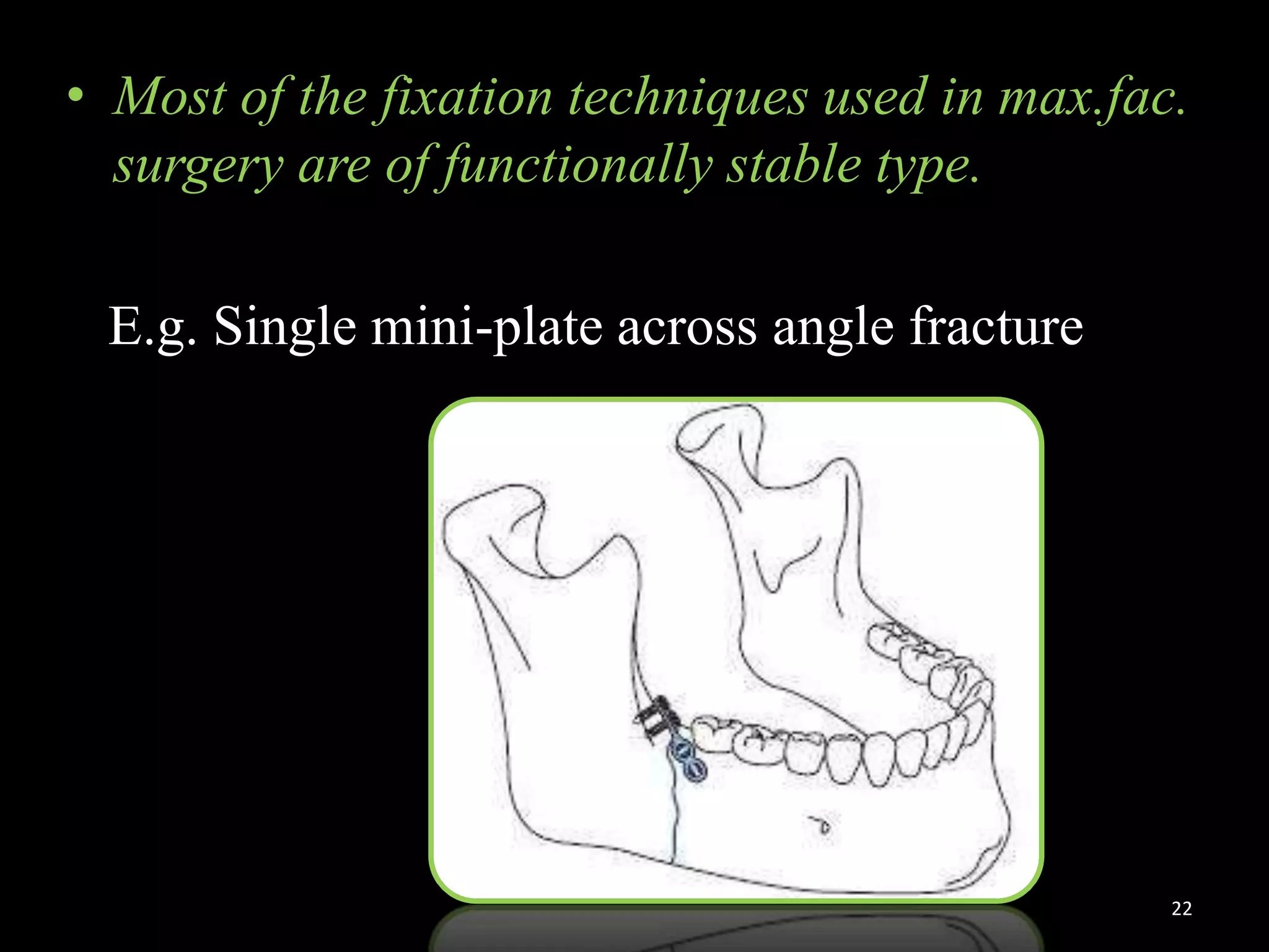 Principles of fixation and osteosynthesis in trauma | PPT