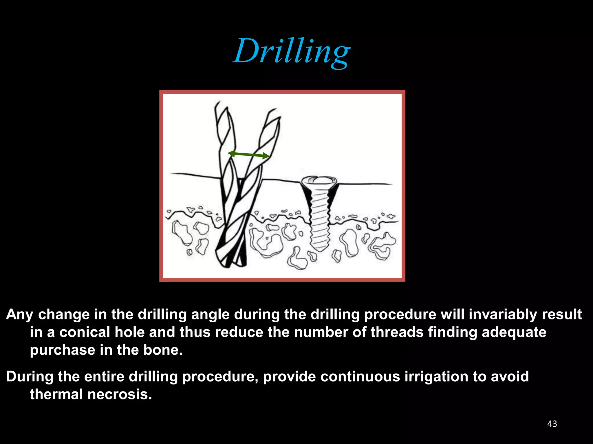 Principles of fixation and osteosynthesis in trauma | PPT