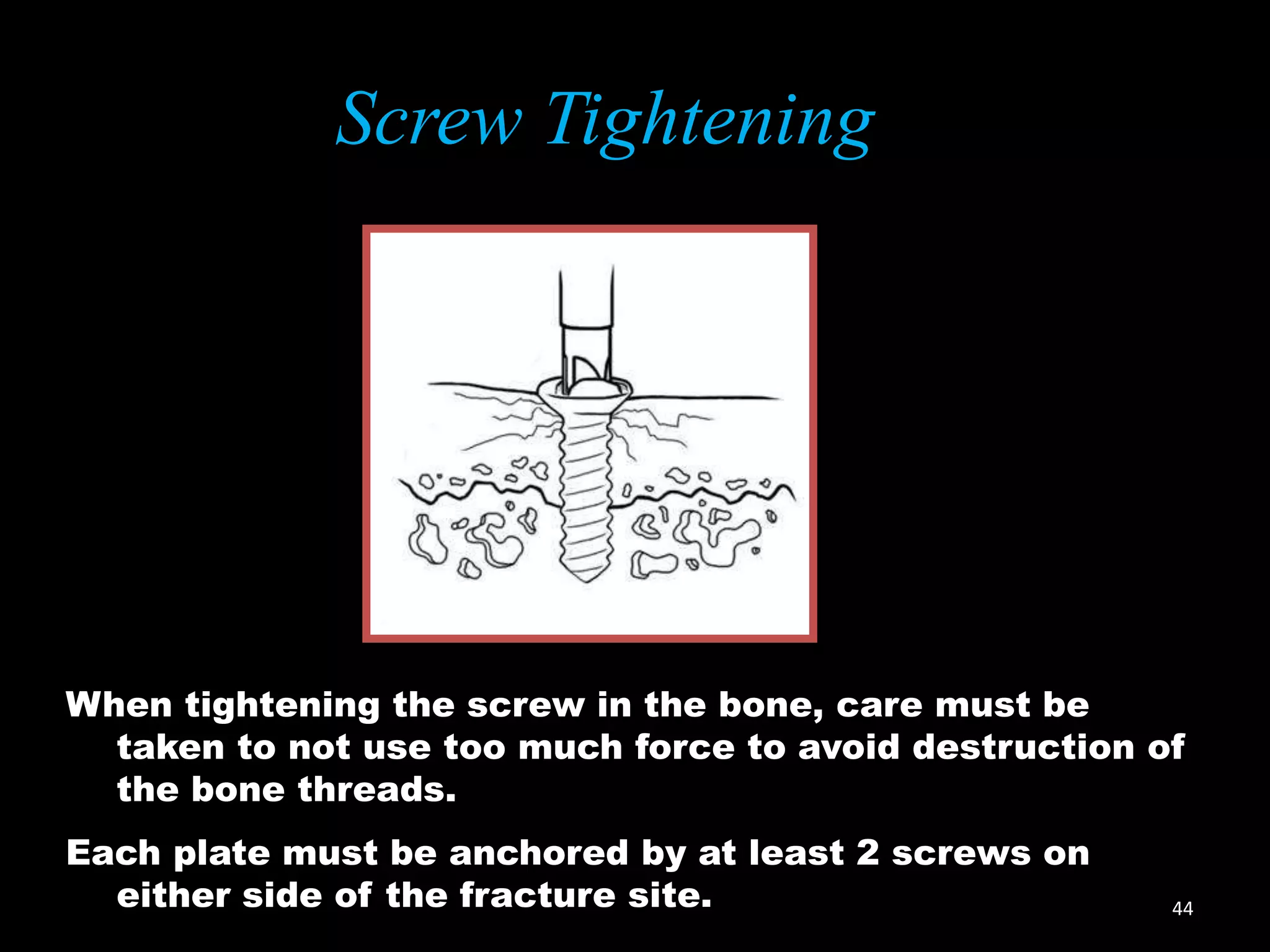 Principles of fixation and osteosynthesis in trauma | PPT