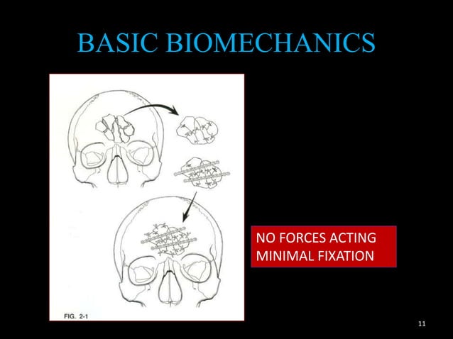 Principles of fixation and osteosynthesis in trauma | PPT
