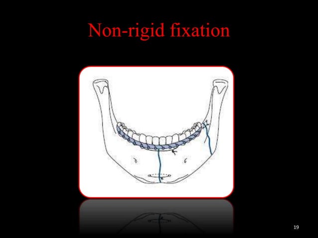 Principles of fixation and osteosynthesis in trauma | PPT