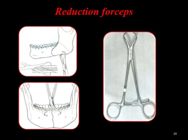 Principles of fixation and osteosynthesis in trauma | PPT