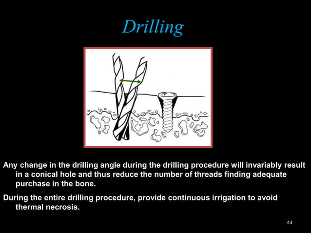 Principles of fixation and osteosynthesis in trauma | PPT