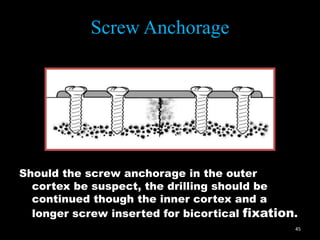 Principles of fixation and osteosynthesis in trauma | PPT