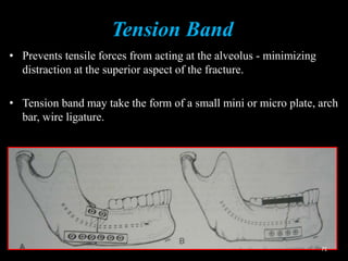 Principles of fixation and osteosynthesis in trauma | PPT