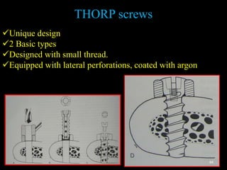 Principles of fixation and osteosynthesis in trauma | PPT