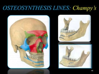 Principles of fixation and osteosynthesis in trauma | PPT