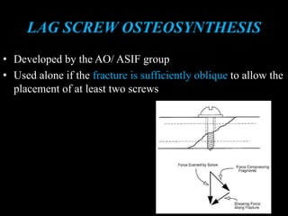Principles of fixation and osteosynthesis in trauma | PPT