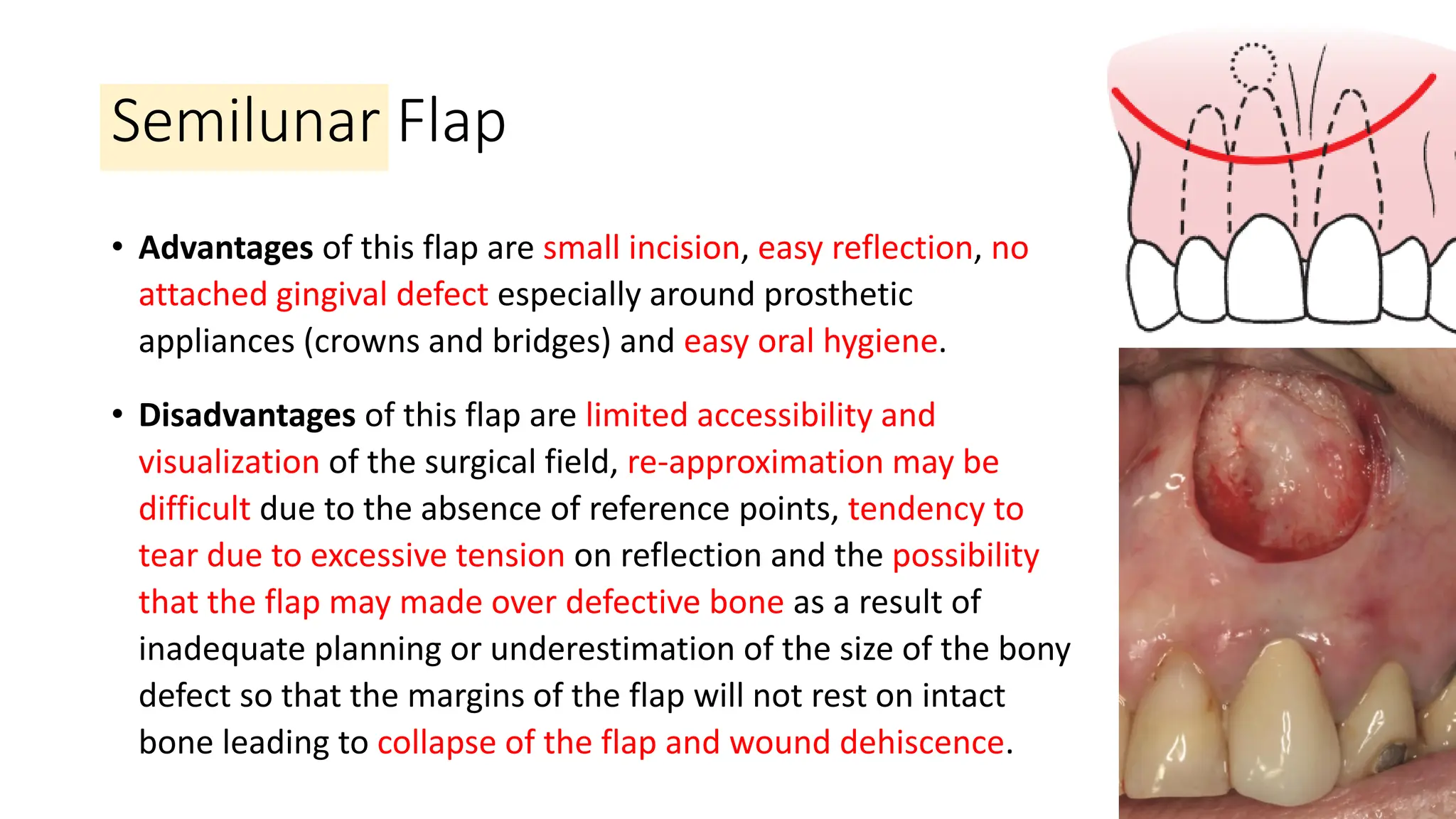 Principles of Flaps, Suturing and Management of difficult extraction.pdf