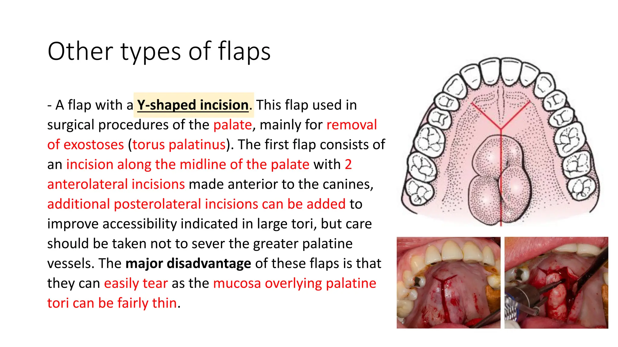 Principles of Flaps, Suturing and Management of difficult extraction.pdf