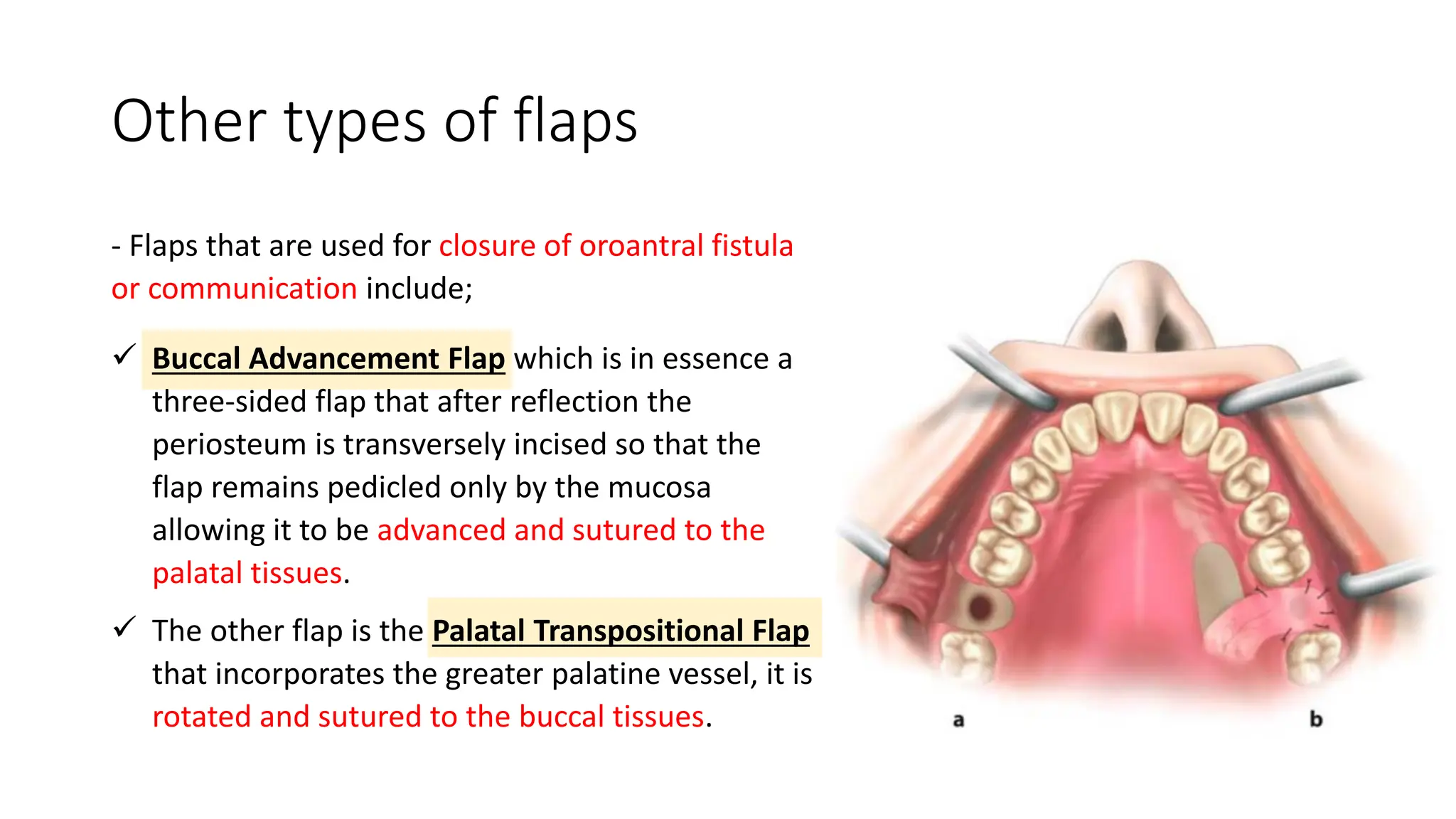 Principles of Flaps, Suturing and Management of difficult extraction.pdf