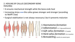 Principles of fracture fixation | PPTX