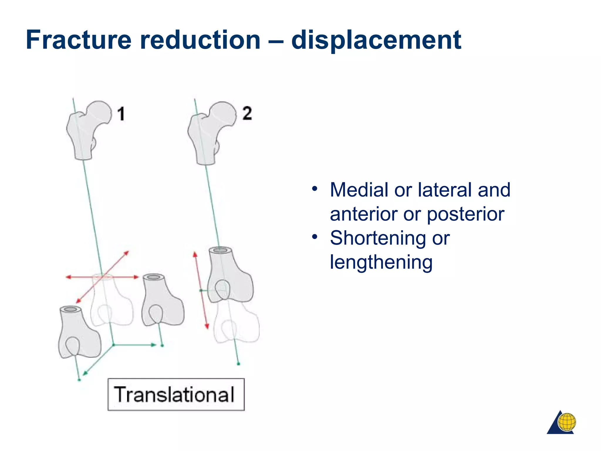 Principles of fracture fixation | PPT