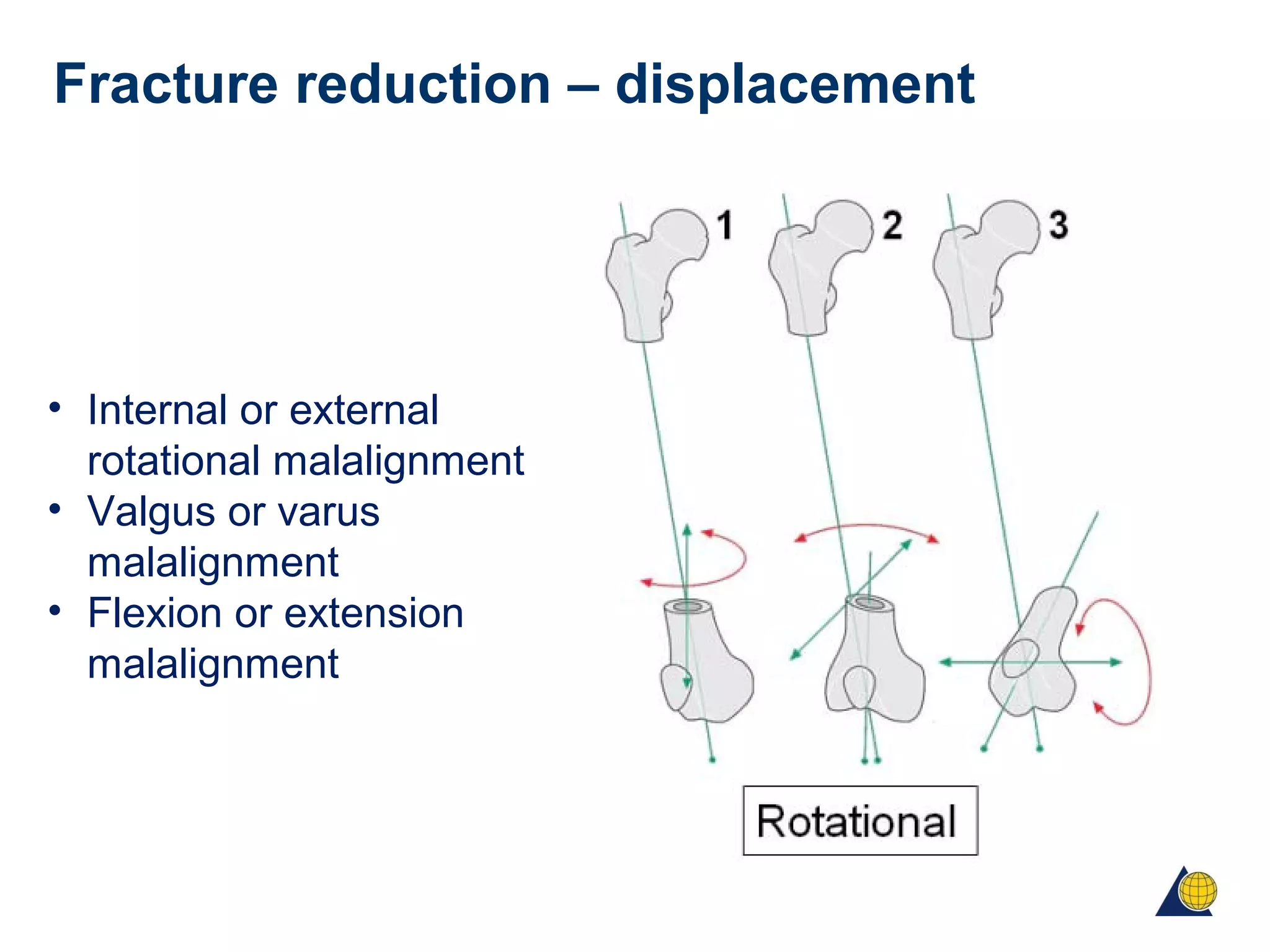 Principles of fracture fixation | PPT