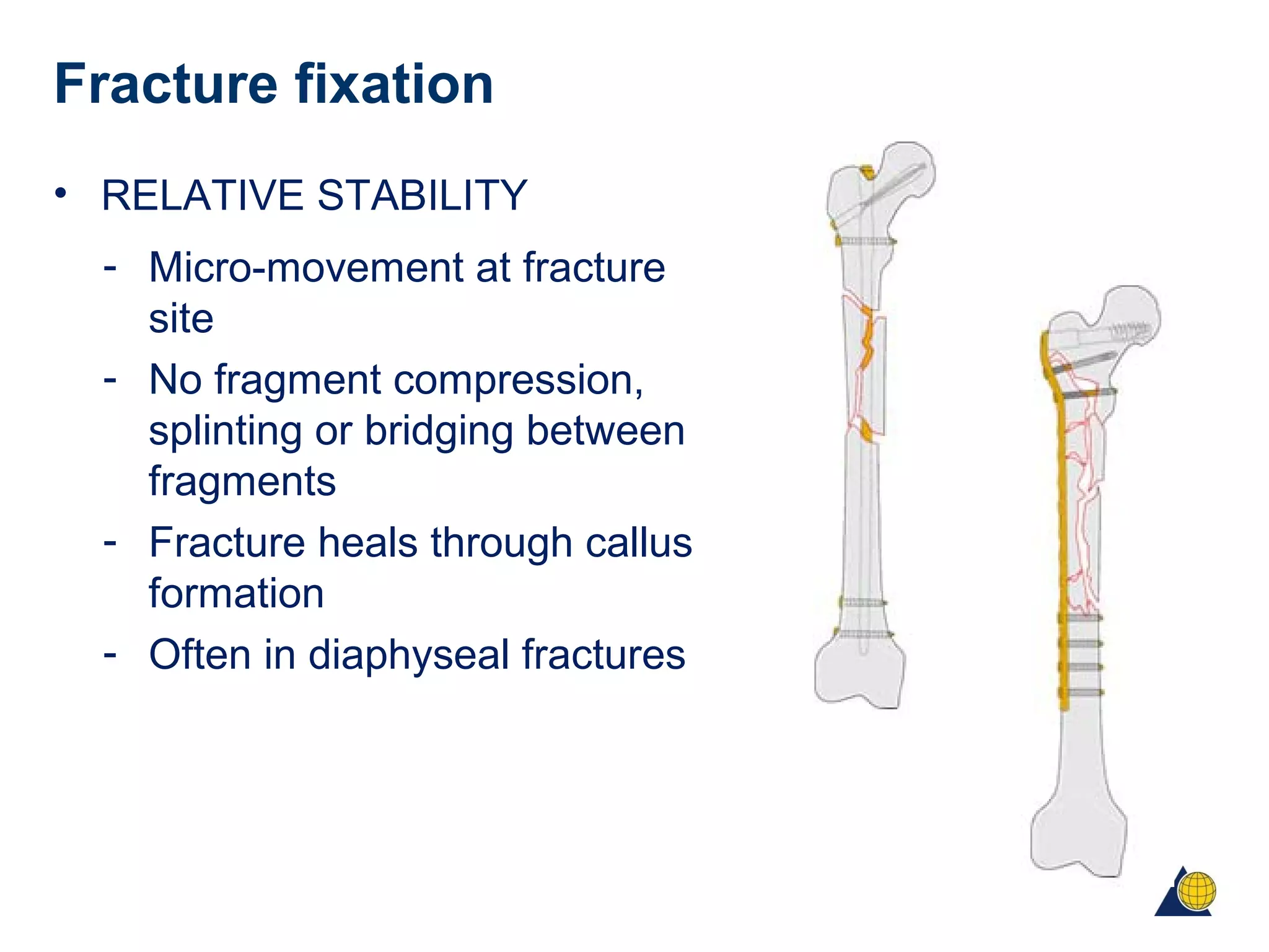 Principles of fracture fixation | PPT