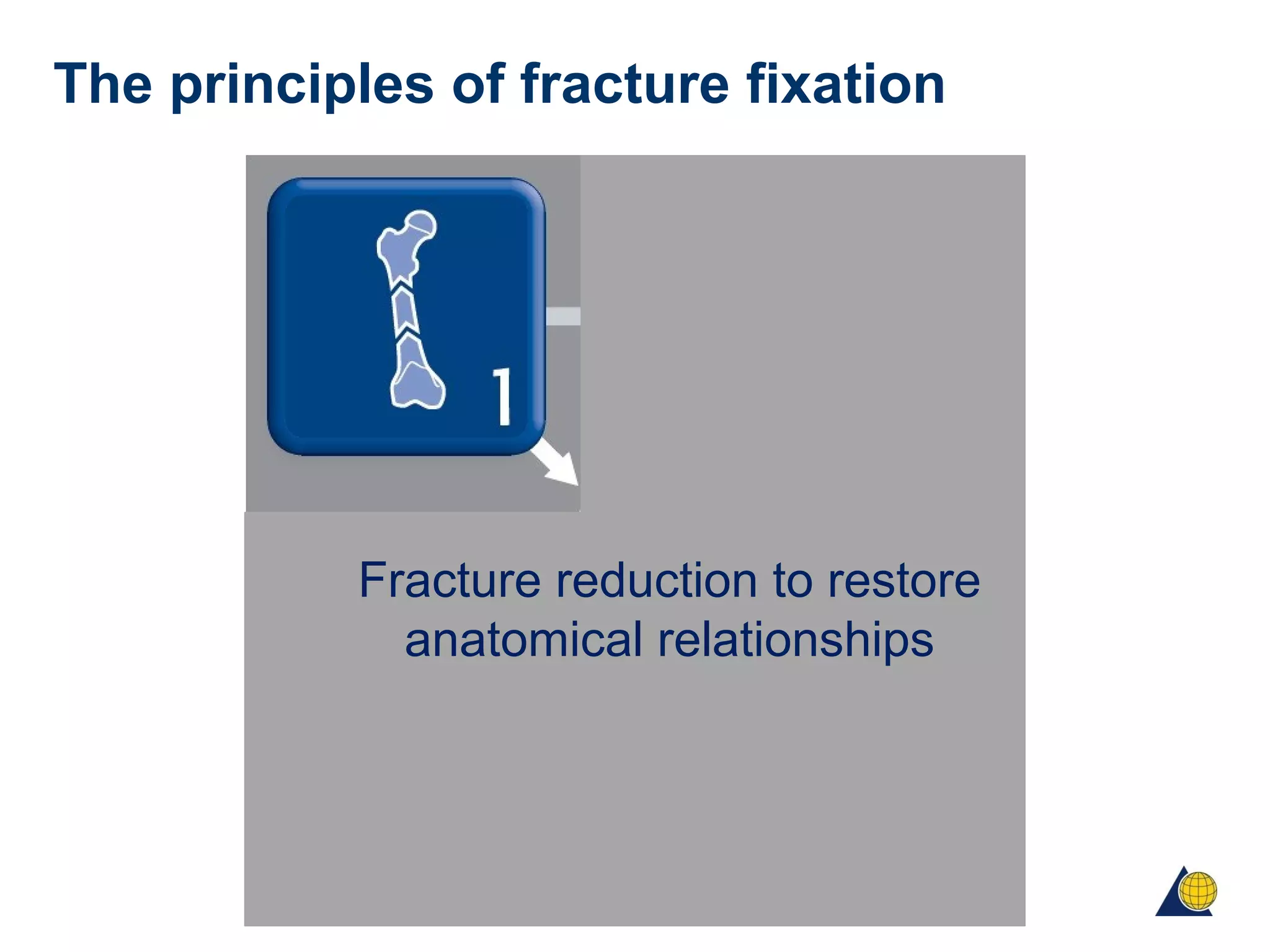 Principles of fracture fixation | PPT