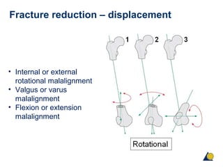 Principles of fracture fixation | PPT
