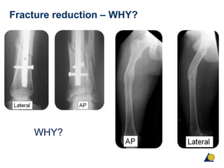 Principles of fracture fixation | PPT
