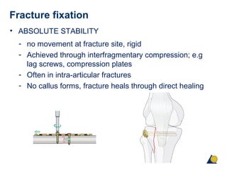 Principles of fracture fixation | PPT