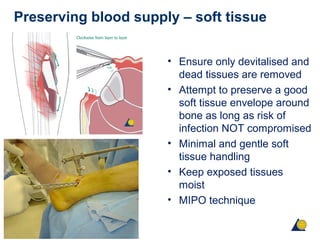 Principles of fracture fixation | PPT