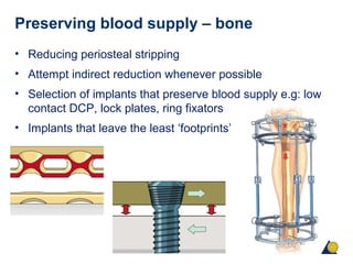Principles of fracture fixation | PPT