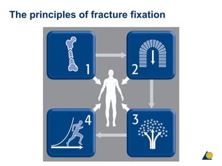 Principles of fracture fixation | PPT