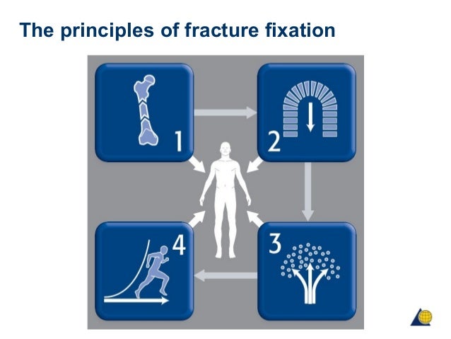 Principles of fracture fixation