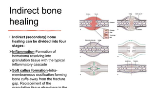 Principles of fracture healing | PPTX