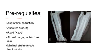 Principles of fracture healing | PPTX