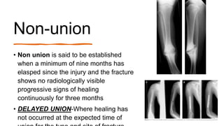 Principles of fracture healing | PPTX