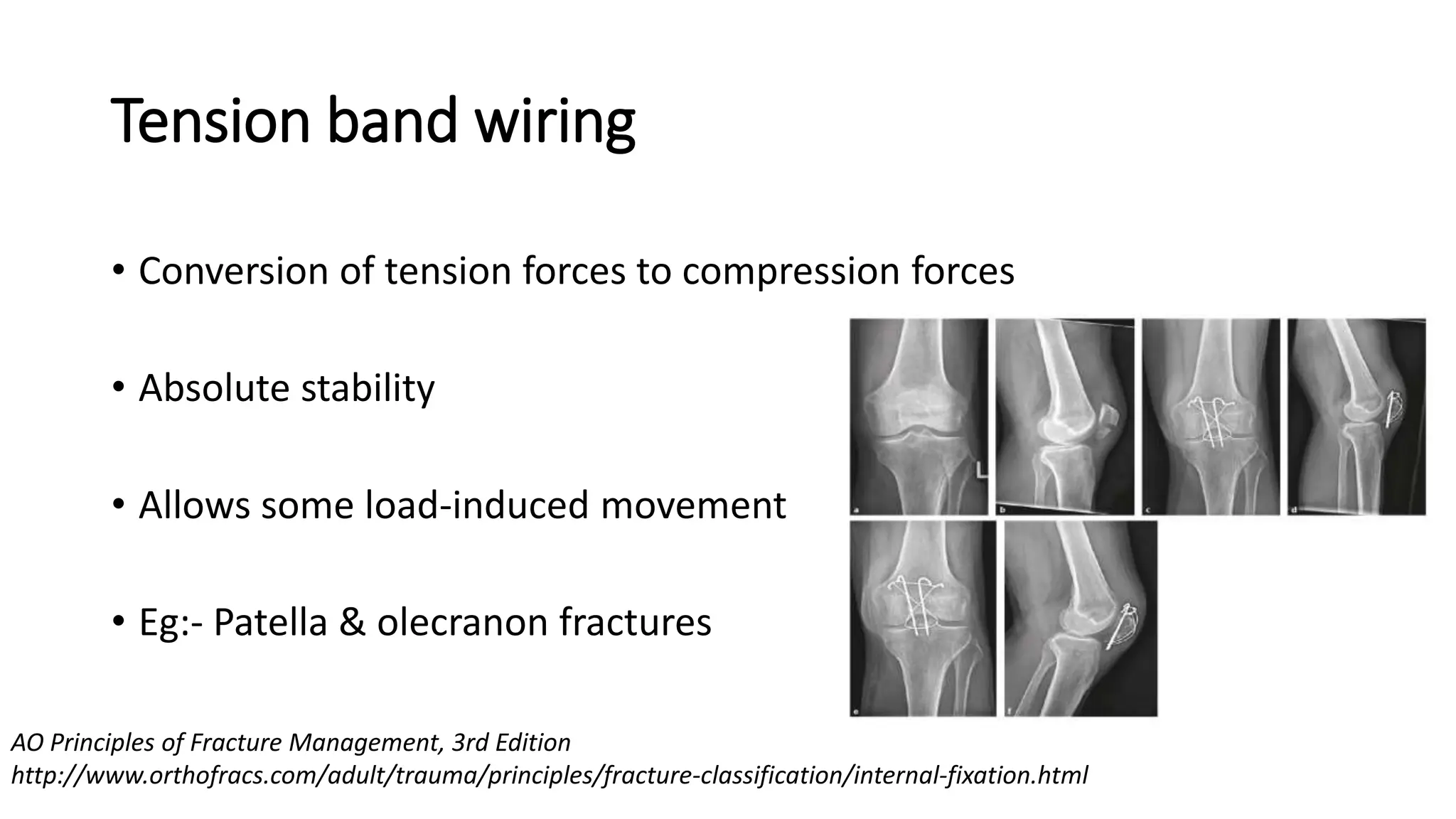 Principles of Fracture Management for General Surgeons.pptx