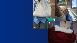 principles of fracture management by plaster cast.pptx