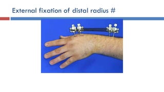 Principles of Fracture Management orthopedics | PPT