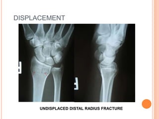 Principles of fracture management Saseendar | PPSX