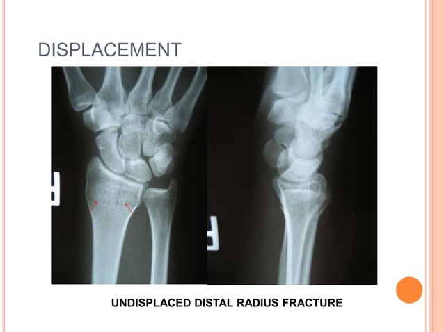 Principles of fracture management Saseendar | PPT