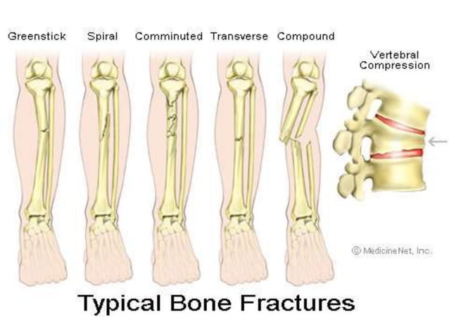 Principles_of_fractures-1.ppt