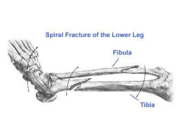 Principles_of_fractures-1.ppt