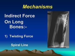 Principles of fractures on orthopedic field | PPT