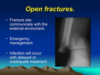 Principles of fractures on orthopedic field | PPT