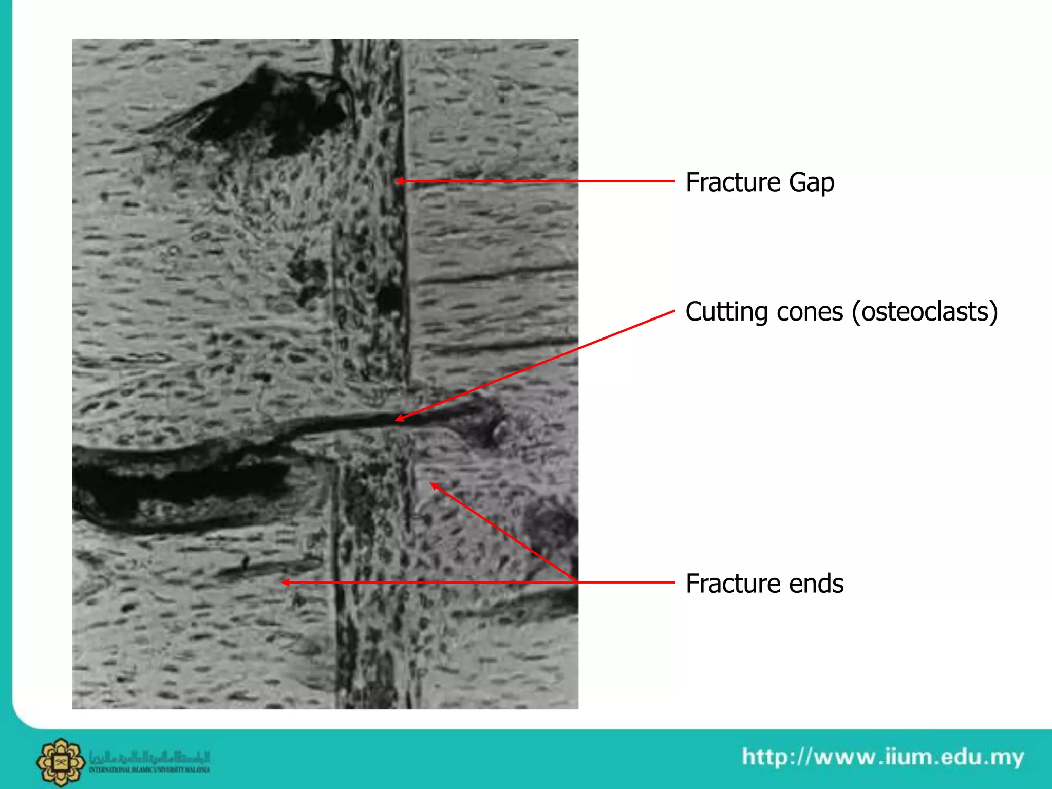 Principles of fractures | PPTX