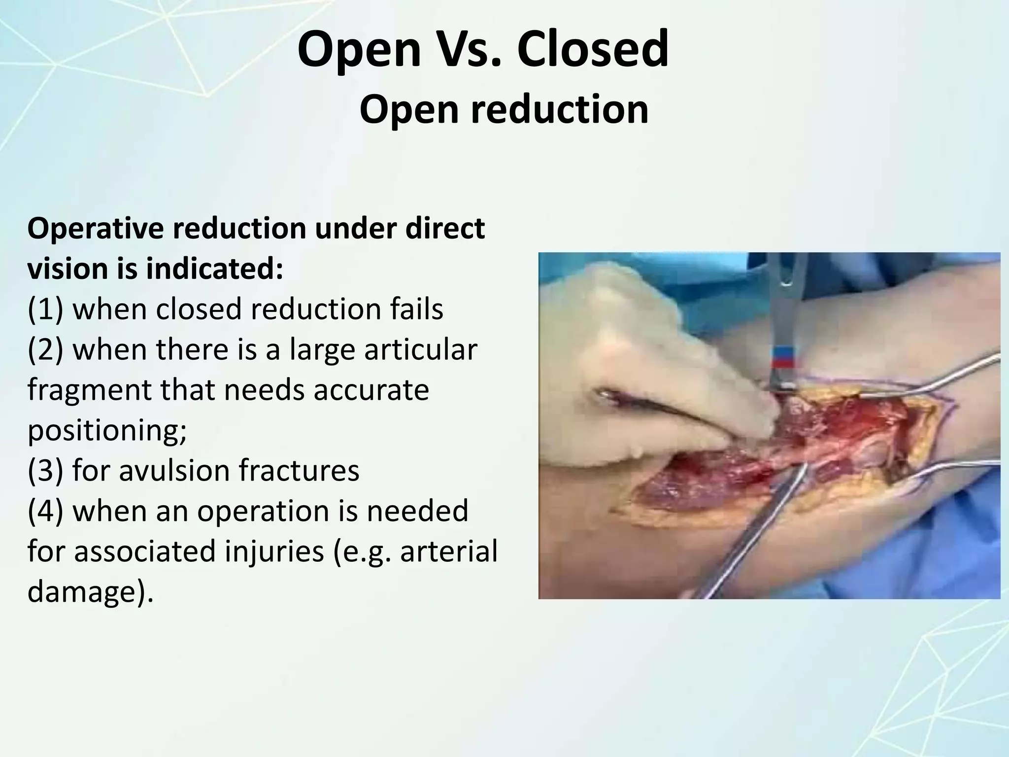 Principles of fractures management | PPTX