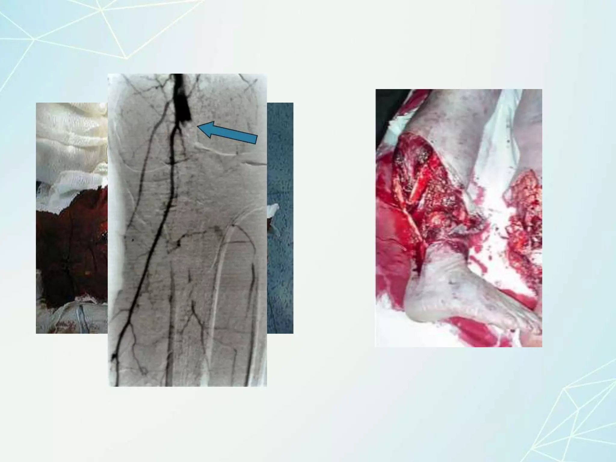 Principles of fractures management | PPTX
